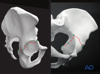 Radiology of the intact acetabulum