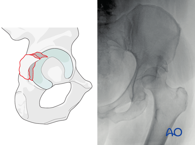 Characteristics of elemental fracture types