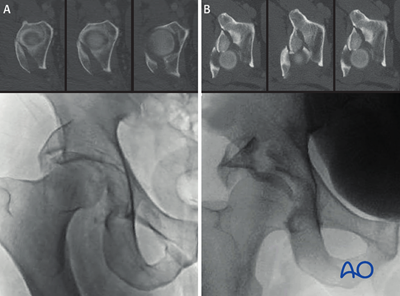 Characteristics of elemental fracture types