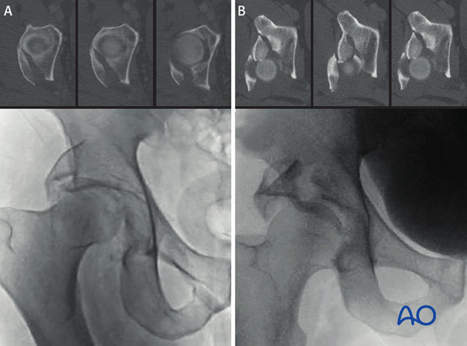 Characteristics of elemental fracture types