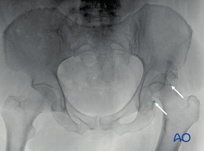 Characteristics of elemental fracture types