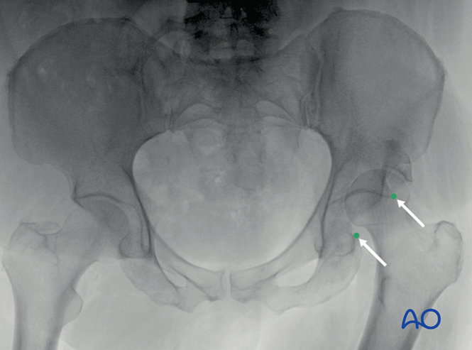 Characteristics of elemental fracture types