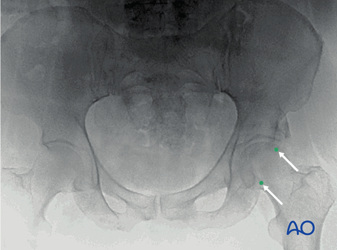 Characteristics of elemental fracture types
