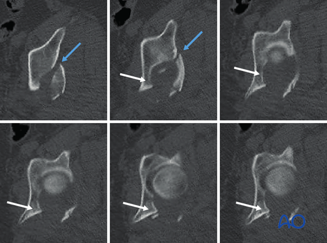 Characteristics of elemental fracture types