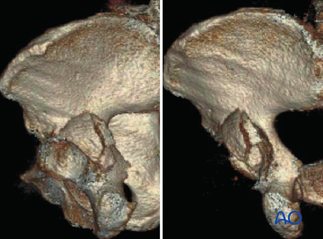 Characteristics of elemental fracture types