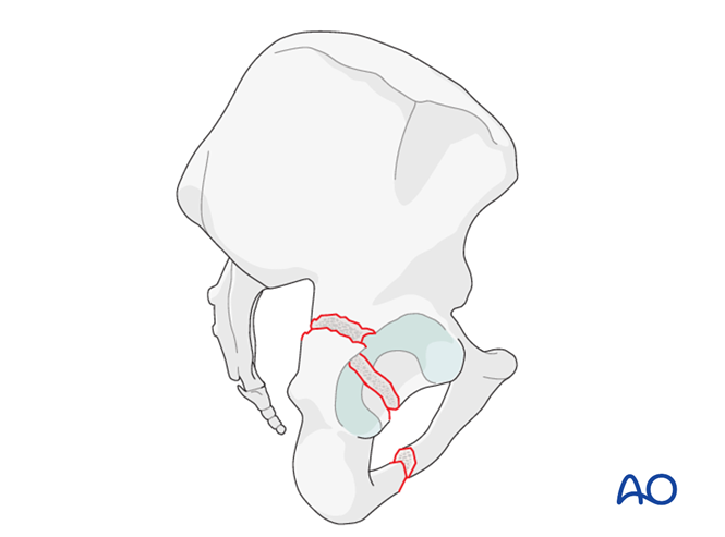 Characteristics of elemental fracture types