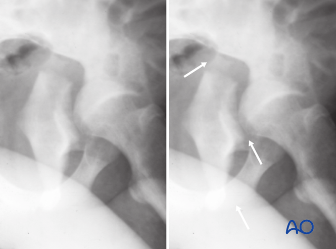 Characteristics of elemental fracture types