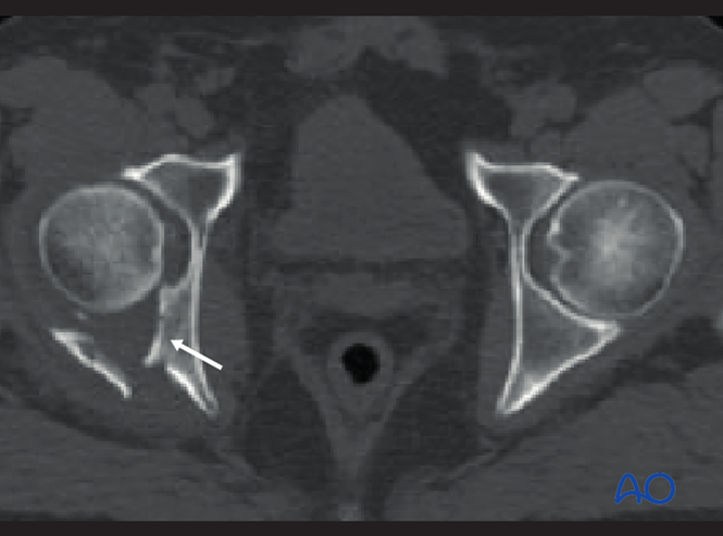 Characteristics of elemental fracture types