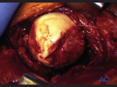 Characteristics of elemental fracture types