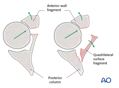 Characteristics of elemental fracture types