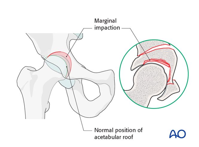 Characteristics of elemental fracture types
