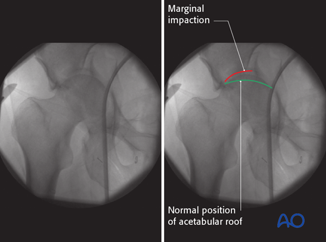 Characteristics of elemental fracture types