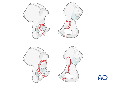 Characteristics of elemental fracture types