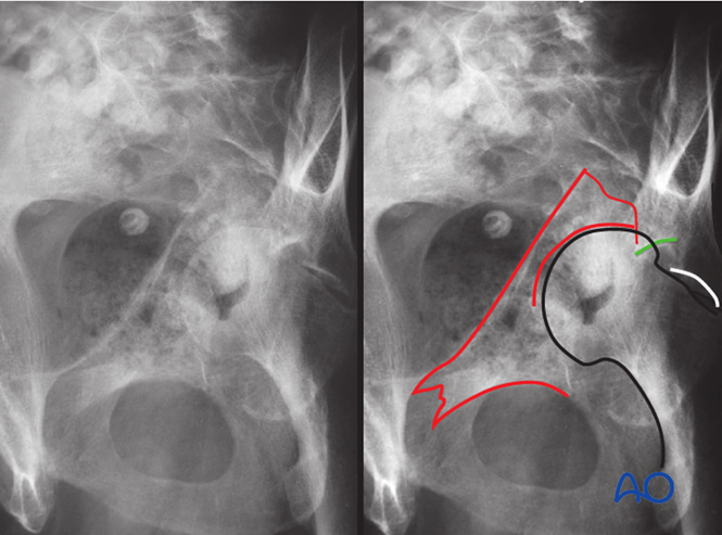 Characteristics of elemental fracture types
