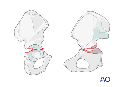 Characteristics of elemental fracture types
