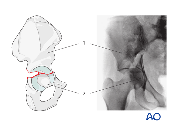 Characteristics of elemental fracture types