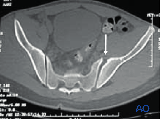 Characteristics of elemental fracture types