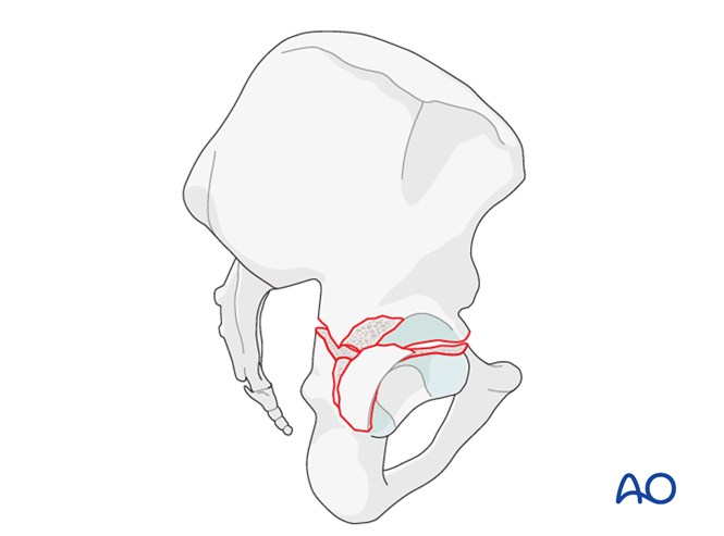 Characteristics of associated fracture types