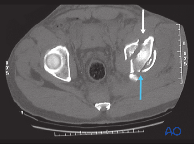 Characteristics of associated fracture types