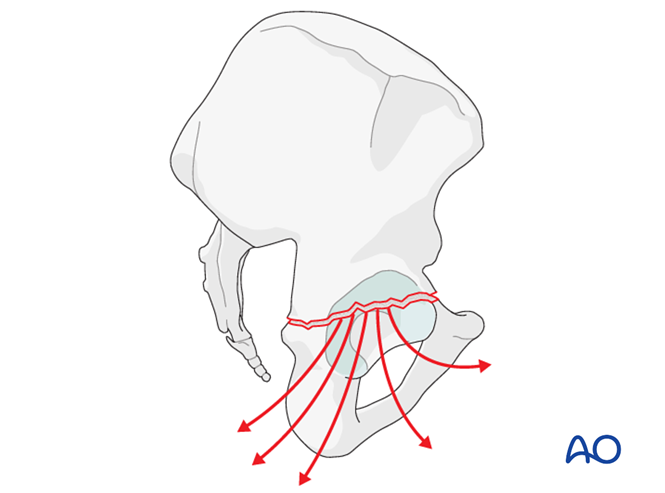 Characteristics of associated fracture types