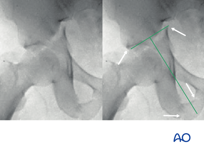 Characteristics of associated fracture types