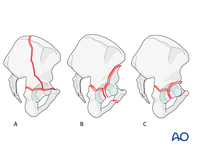 Characteristics of associated fracture types