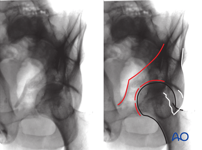 Characteristics of associated fracture types