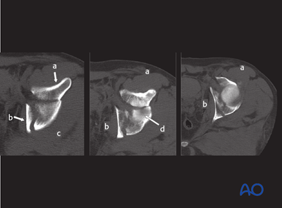 Characteristics of associated fracture types