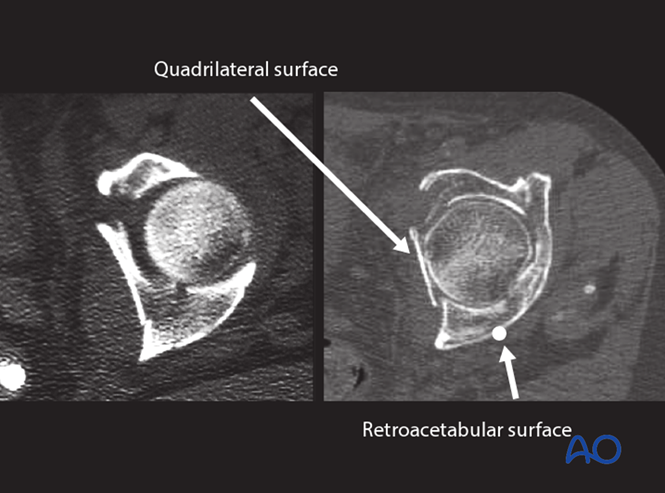 Characteristics of associated fracture types