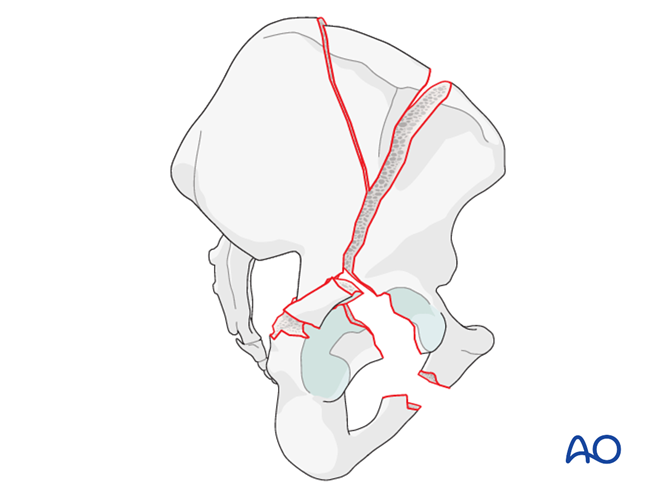 Characteristics of associated fracture types
