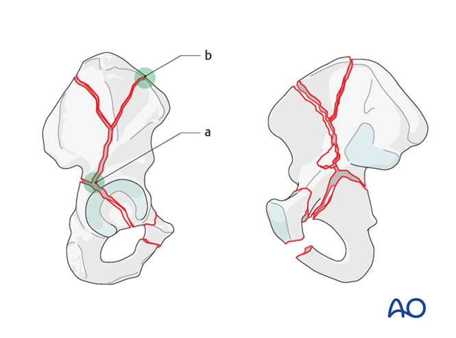Characteristics of associated fracture types