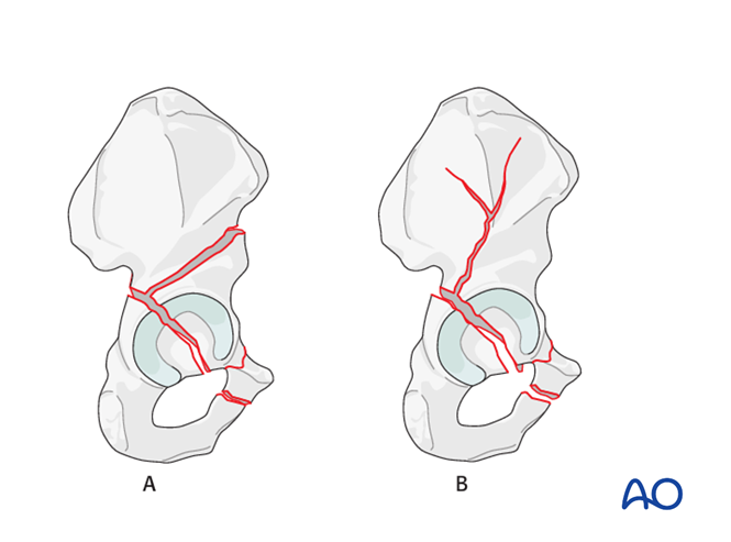 Characteristics of associated fracture types