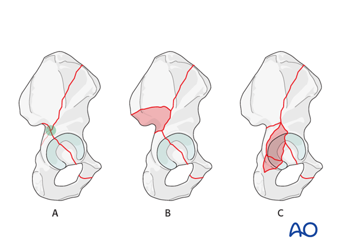 Characteristics of associated fracture types