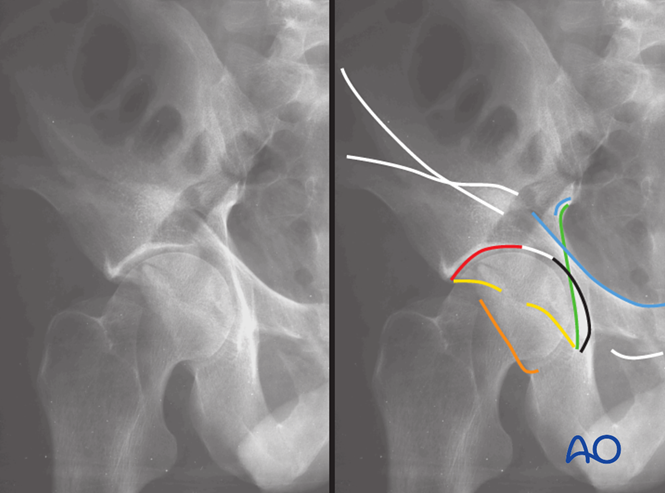 Characteristics of associated fracture types