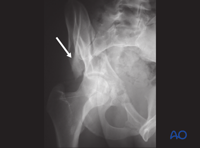 Radiology of the intact acetabulum
