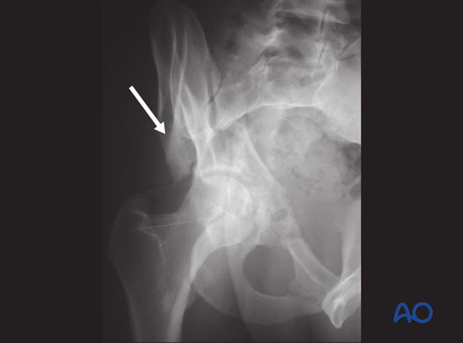 Radiology of the intact acetabulum