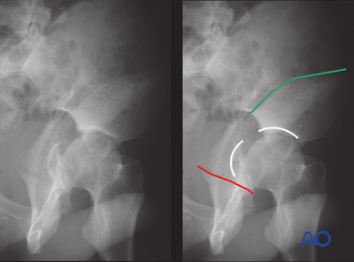 Characteristics of associated fracture types