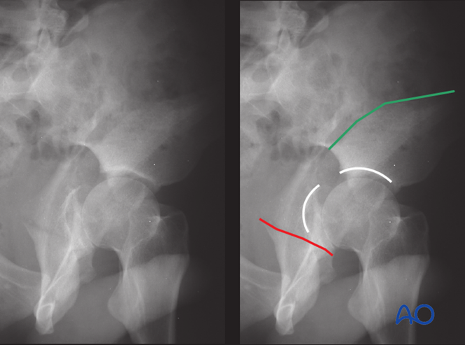 Characteristics of associated fracture types