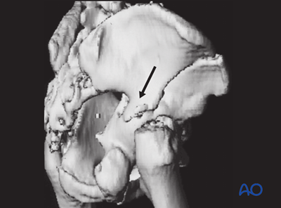 Characteristics of associated fracture types