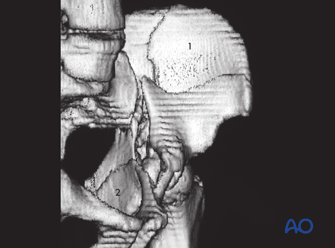 Characteristics of associated fracture types