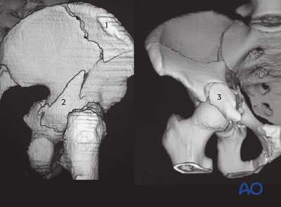 Characteristics of associated fracture types