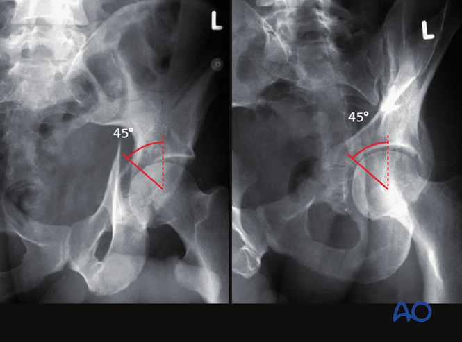 Characteristics of elemental fracture types