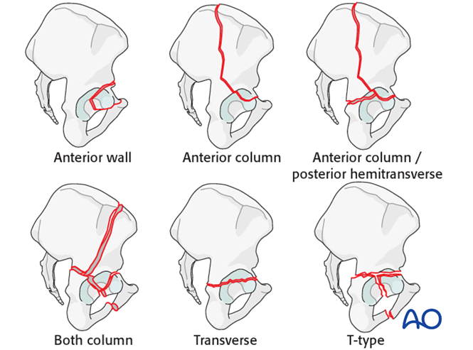 Decision making: choice of exposure