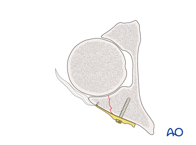 Basic technique: spring hook plates