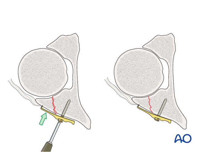 Basic technique: spring hook plates