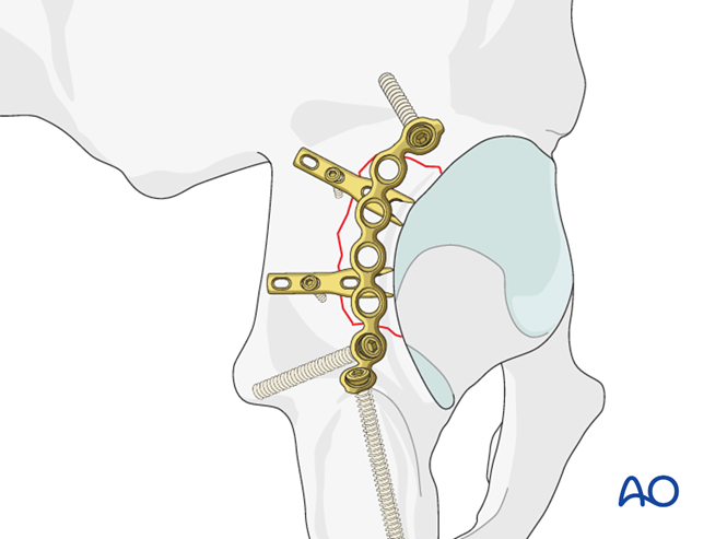 Basic technique: spring hook plates