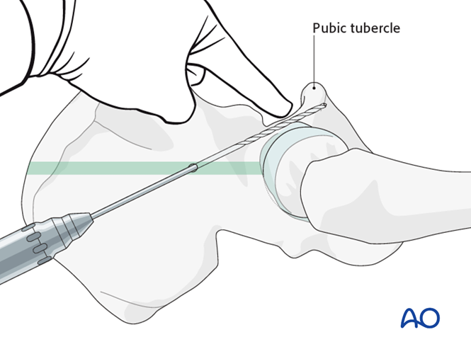 General stabilization principles and screw directions