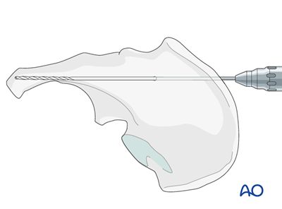 General stabilization principles and screw directions