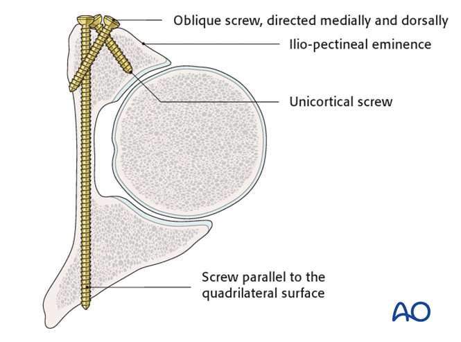 General stabilization principles and screw directions
