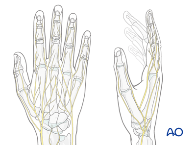 Digital nerve lesions in the hand